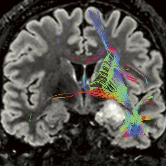 Neuro imaging with 48-channel Head Coil