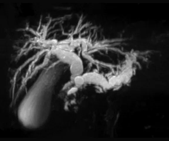 3D MRCP with HyperSense: an evaluation of respiratory-triggered and breath-hold sequences