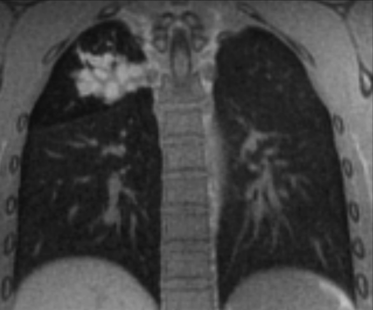 Hyperpolarized gas lung imaging