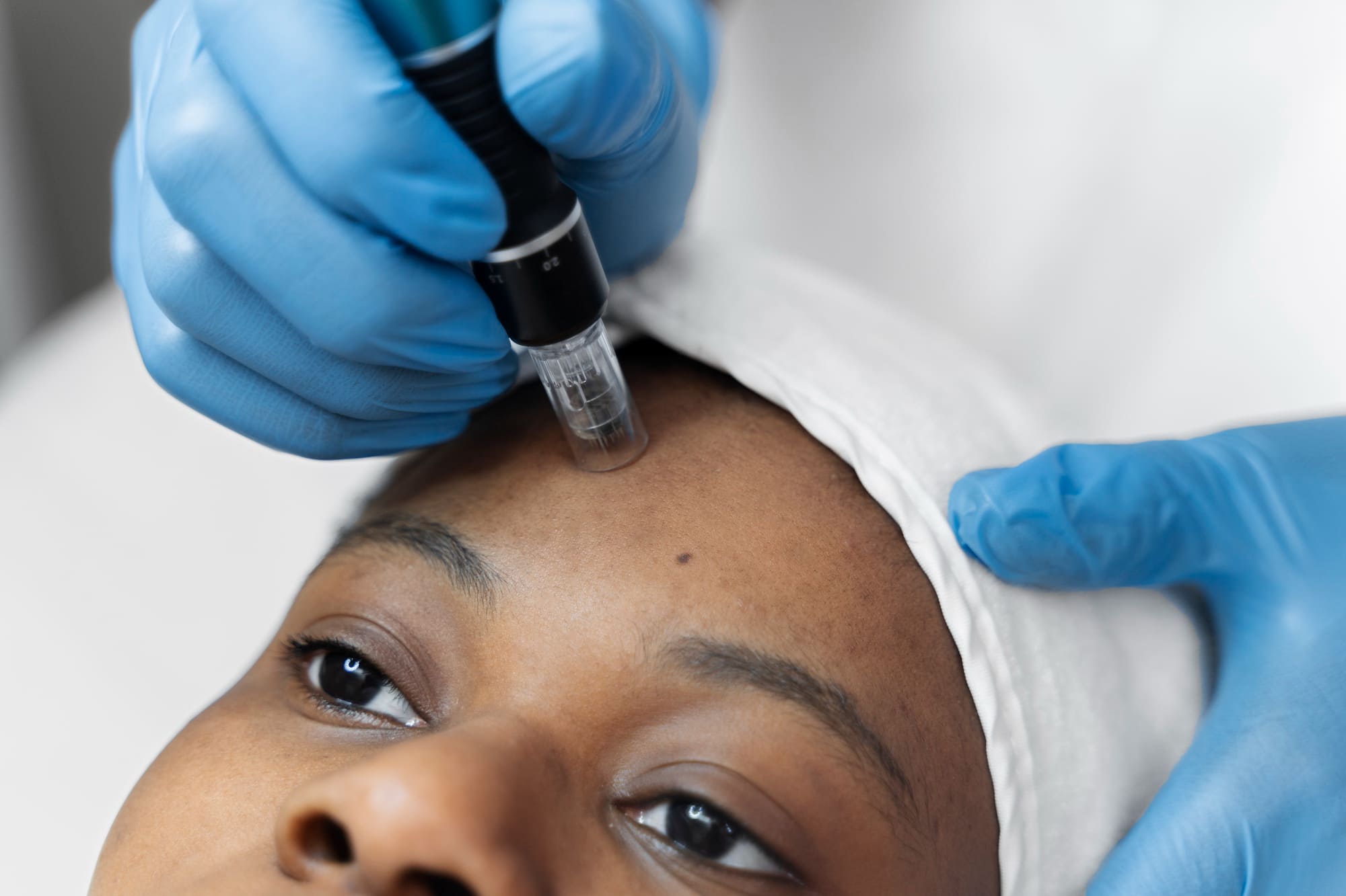 Regular Microneedling - Numi Aesthetics