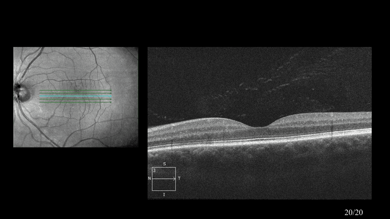 West Coast Retina