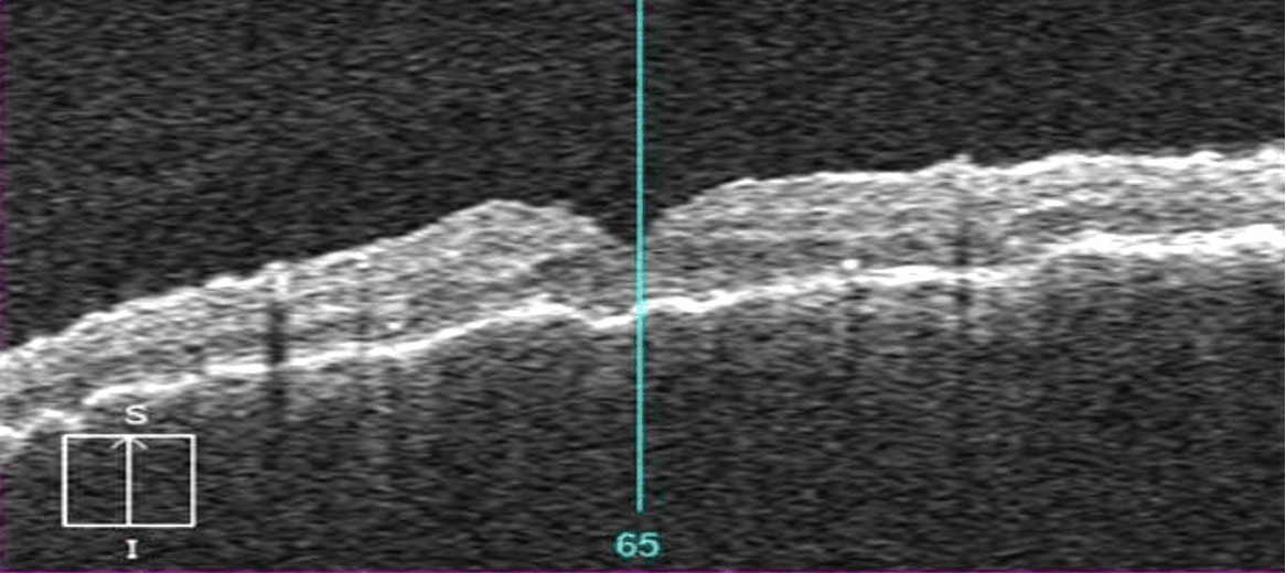 West Coast Retina