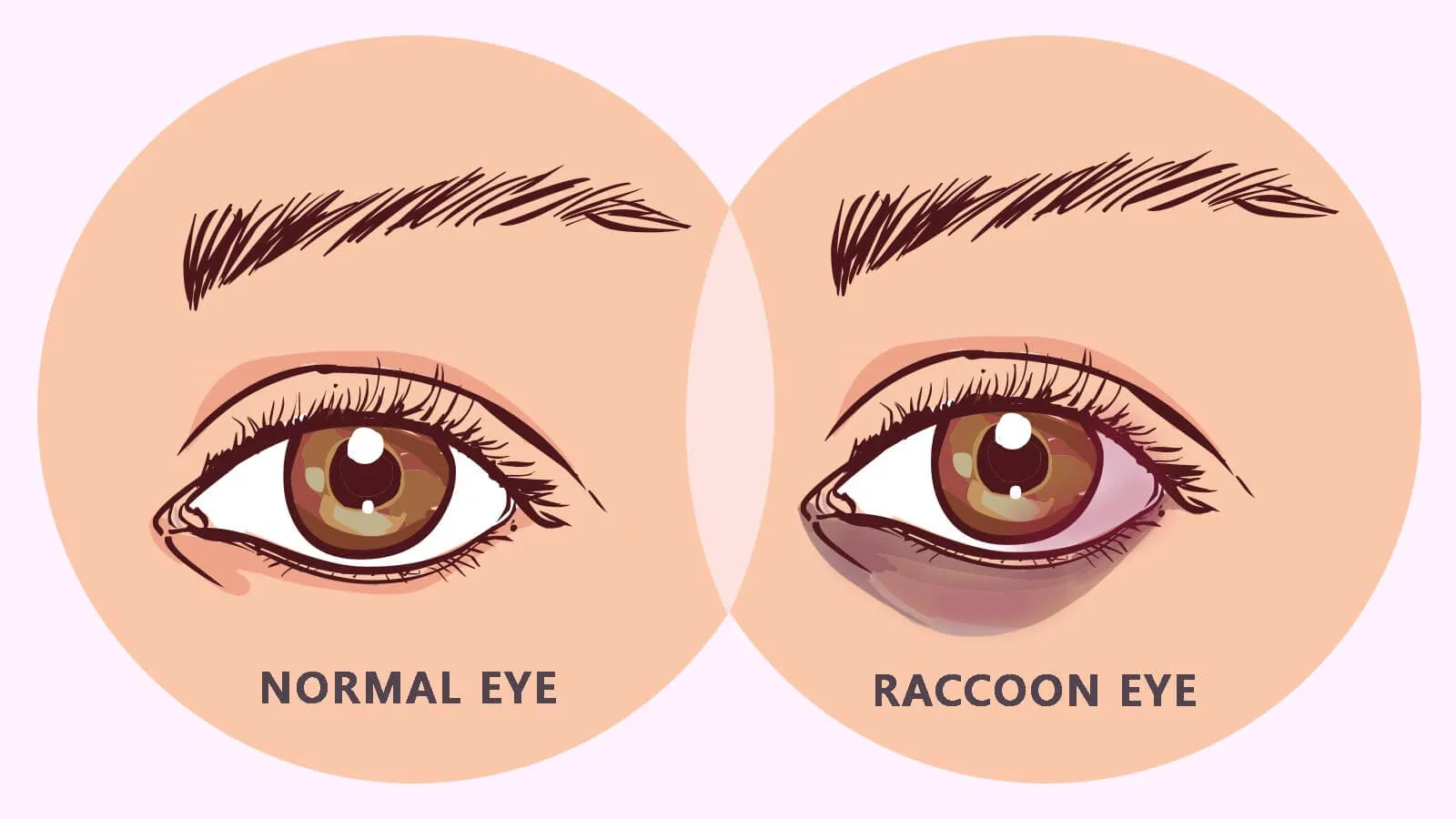 Raccoon Eyes Condition - Its Symptoms, Causes, Complications and More