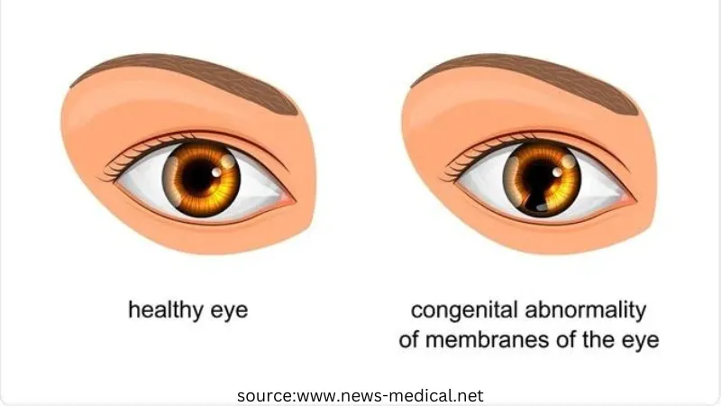 Know about coloboma eyes! | Specscart