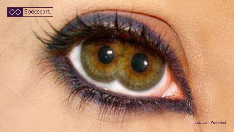 Polycoria: Symptoms, Causes & Treatment