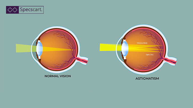 Astigmatism Example Astigmatism Eye Defects