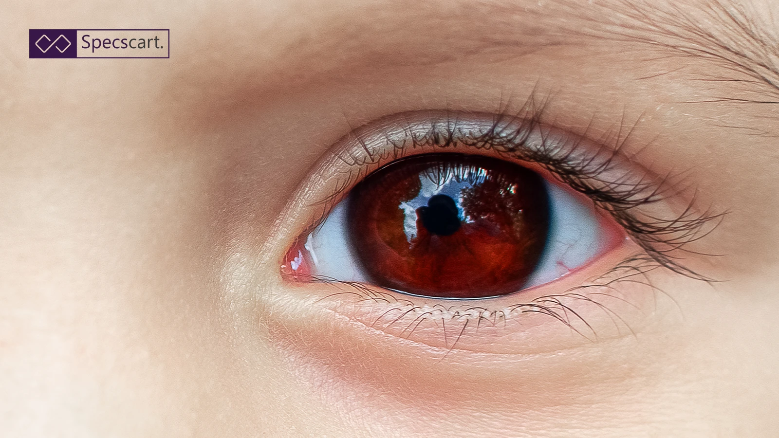 What is Hyphema: Causes, Symptoms, Diagnosis and Treatment? | Specscart