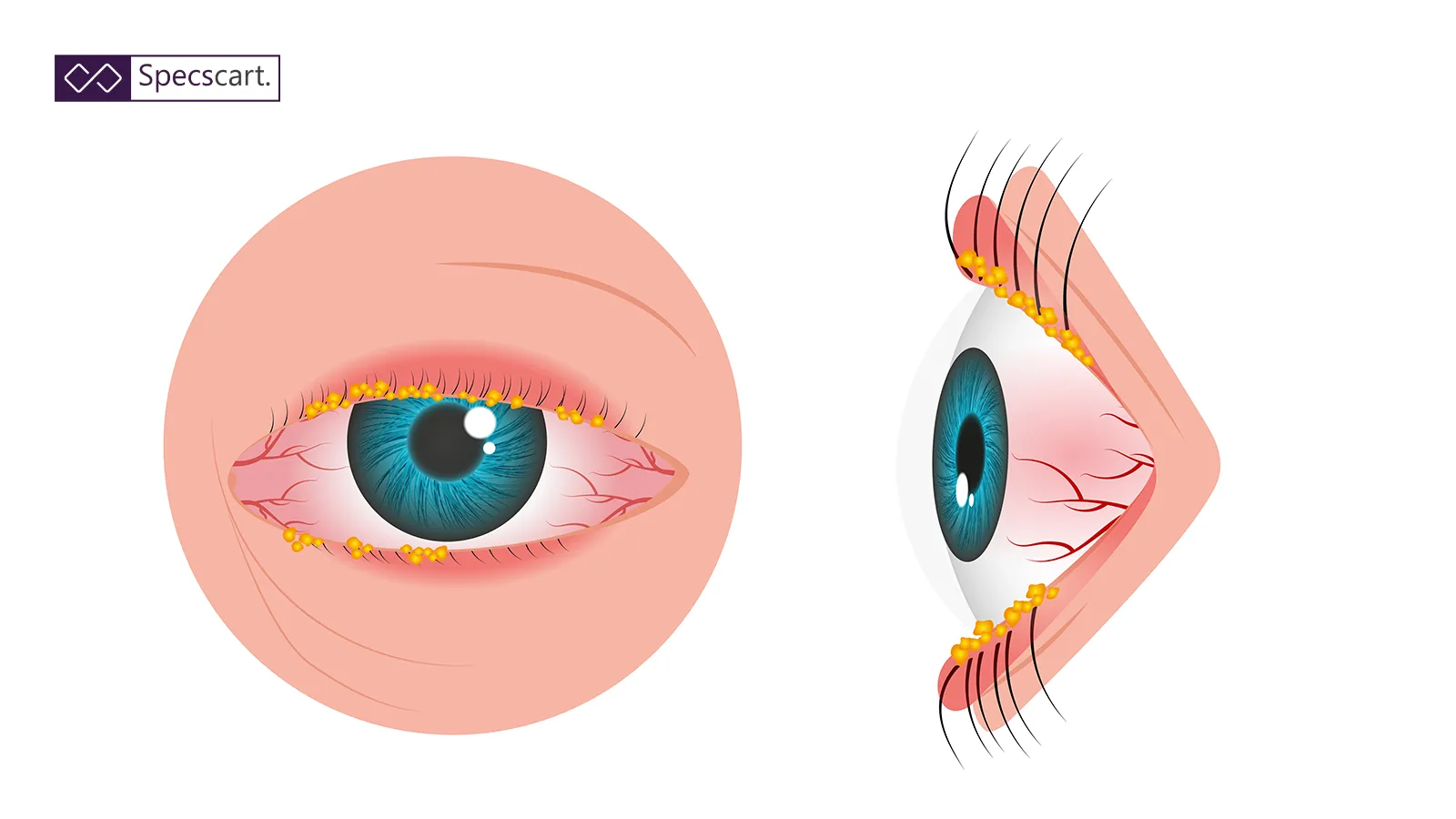 What is Eye Discharge? Why Does it Develop Around the Eye? | Specscart