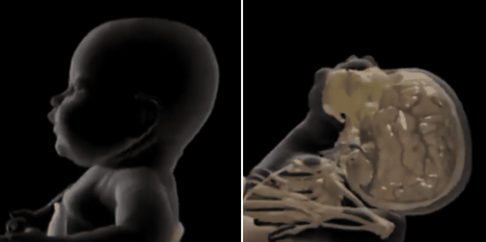 Síndrome do bebé abanado: o que é, tratamento e prognóstico - Mundo das ...