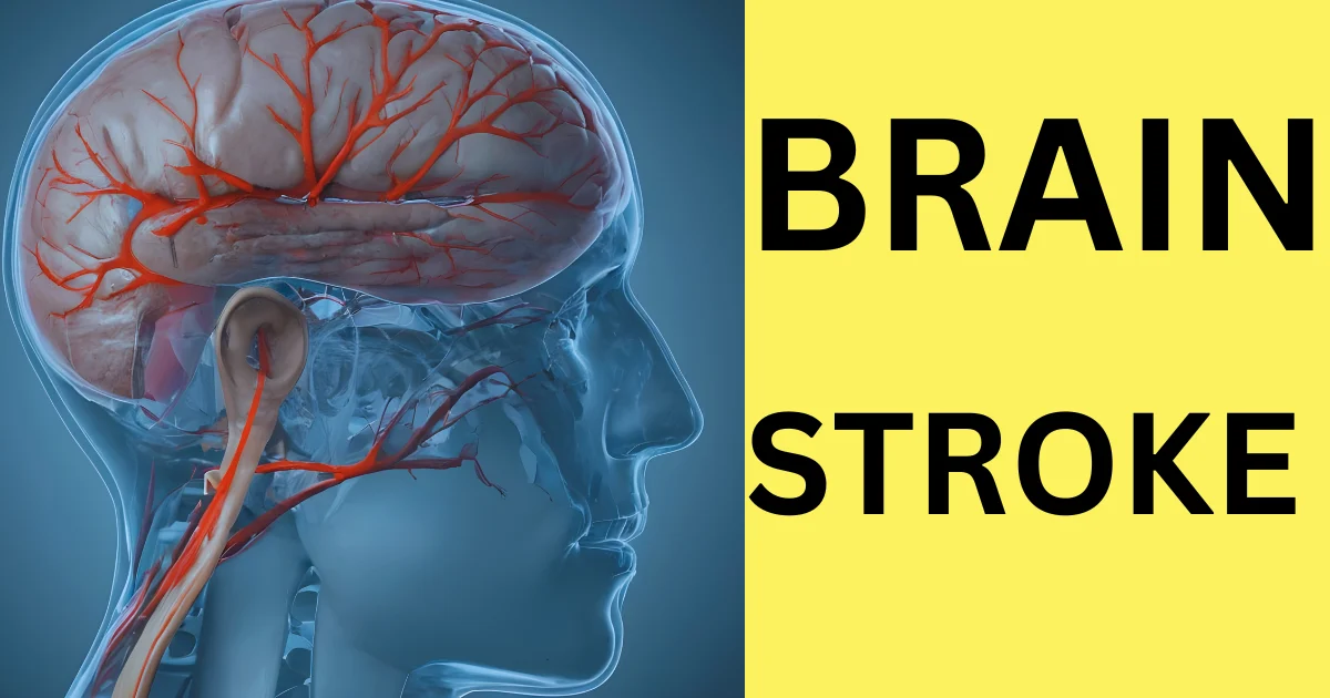 Brain Stroke In Hindi: Causes And Symptoms / ब्रेन स्ट्रोक : कारण और लक्षण