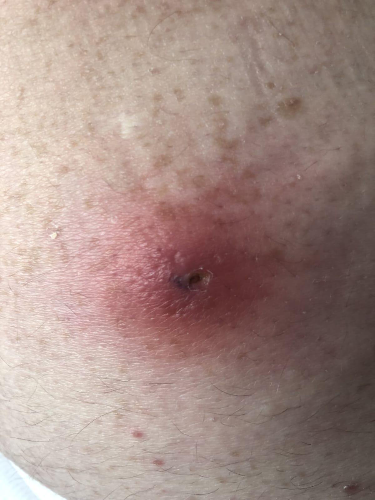 Myiasis – Überblick über eine parasitäre Erkrankung