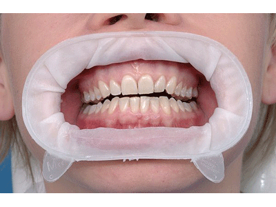 OptraGate regular refill - denta.be