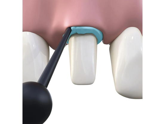 Retraction paste - denta.be