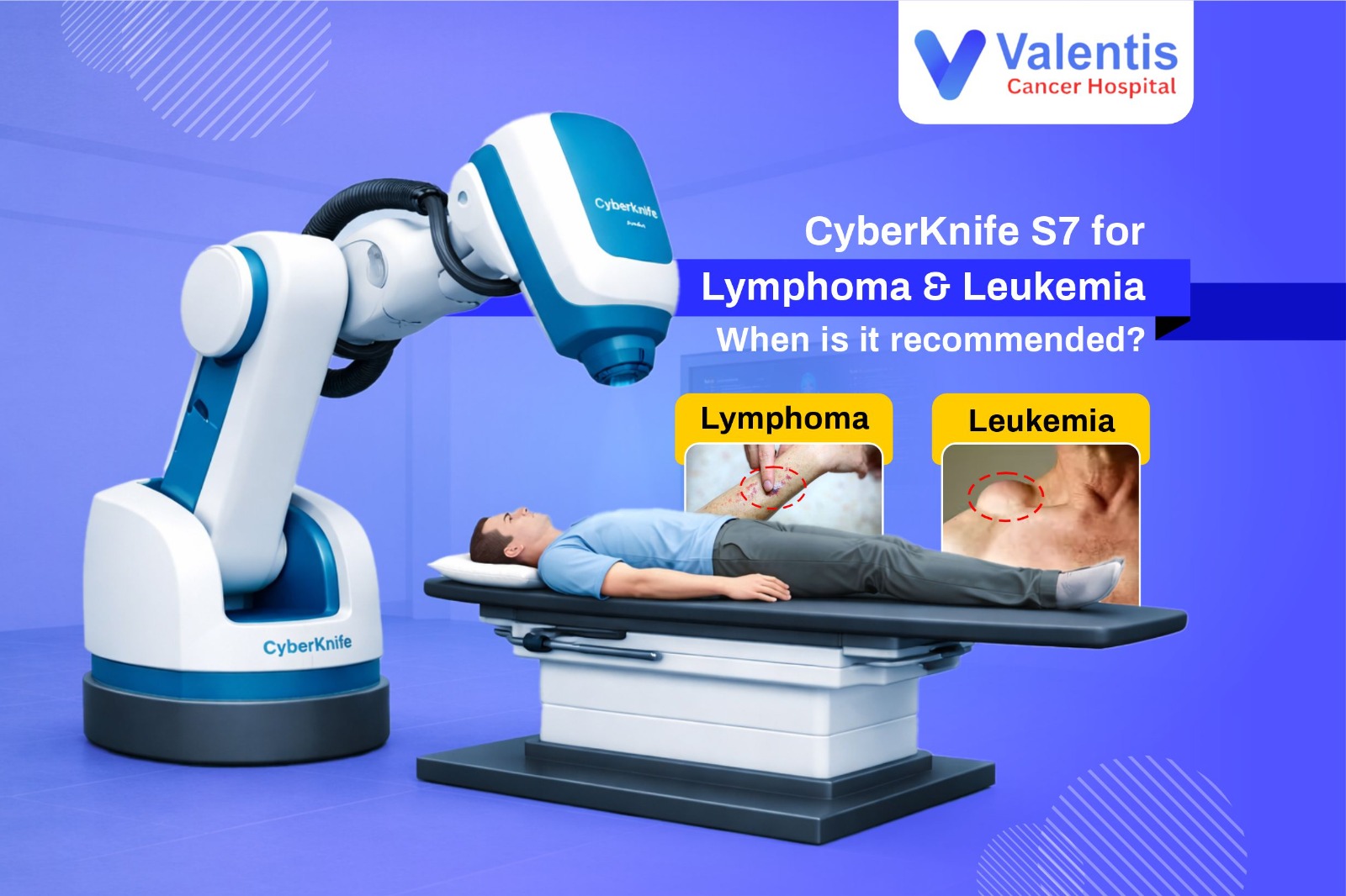 CyberKnife S7 for Lymphoma & Leukemia: When Recommended?