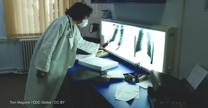 What does a future with AI-aided TB screening look like? | Devex