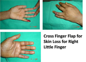 Upper Limb & Hand Defects - Tandon Clinic