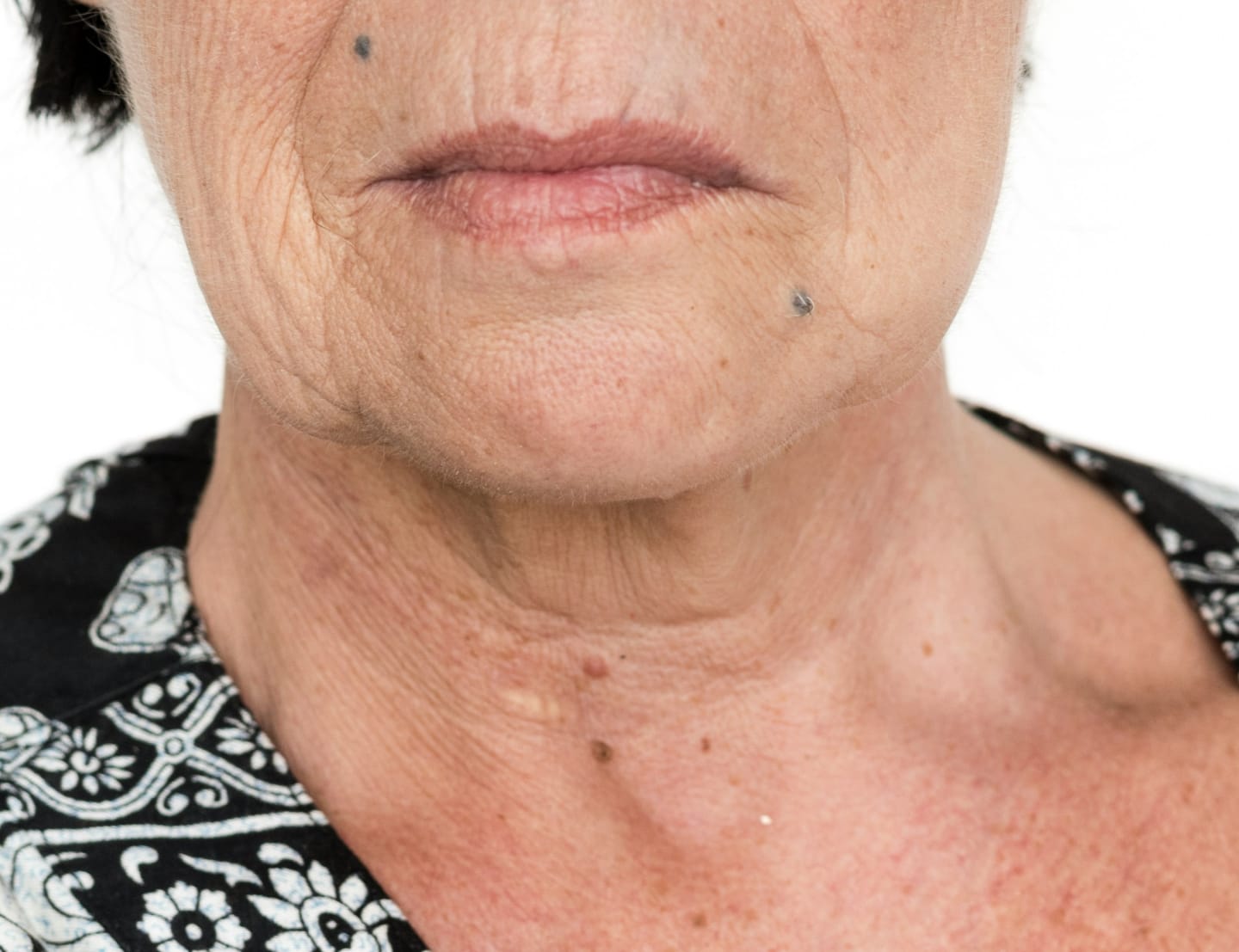 How To Treat Jowls And Restore A More Defined Jawline • Dr Jenny Clinic