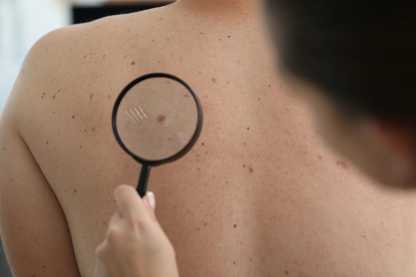Mole Removal: What You Need To Know • Dr Jenny Clinic