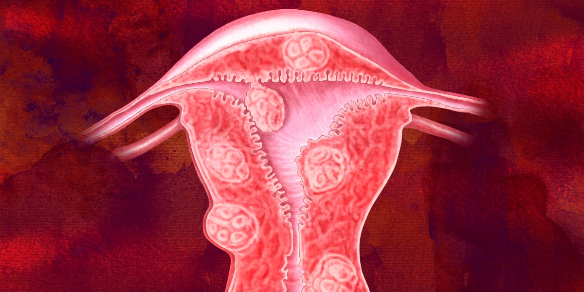 Examining Increases in ED Visits for Leiomyomas