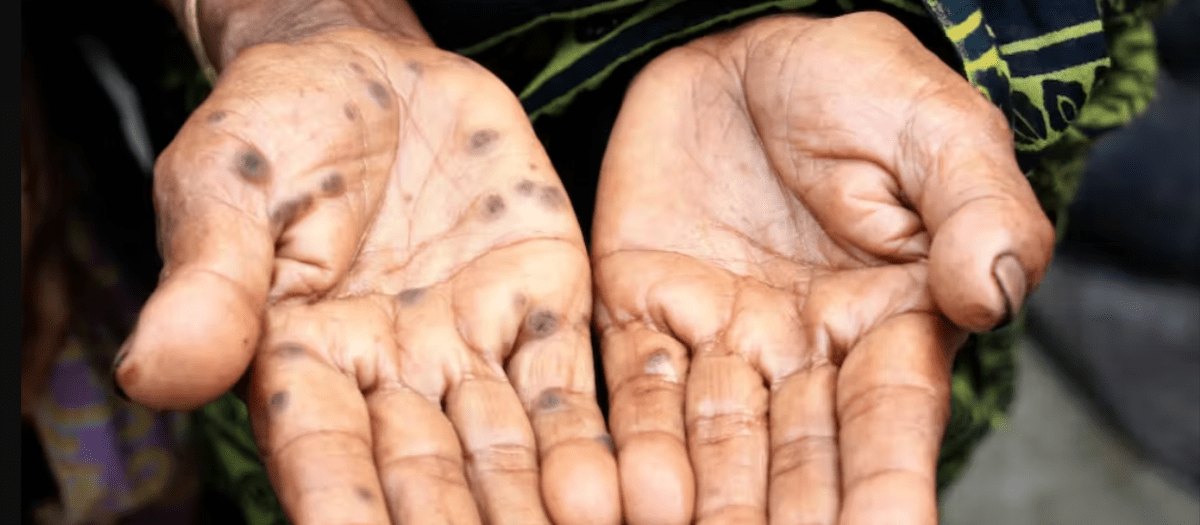 Arsenic contamination of food and water is a global public health ...