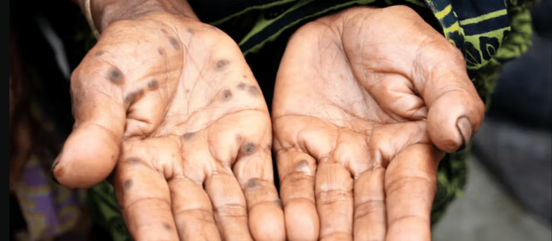 Arsenic contamination of food and water is a global public health ...