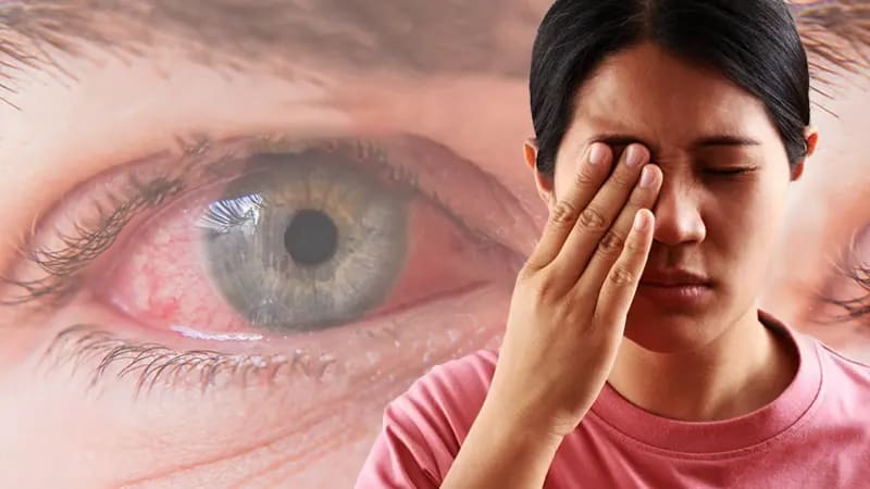 Eye Flu (conjunctivitis): Symptoms, Care & Treatment [Updated]
