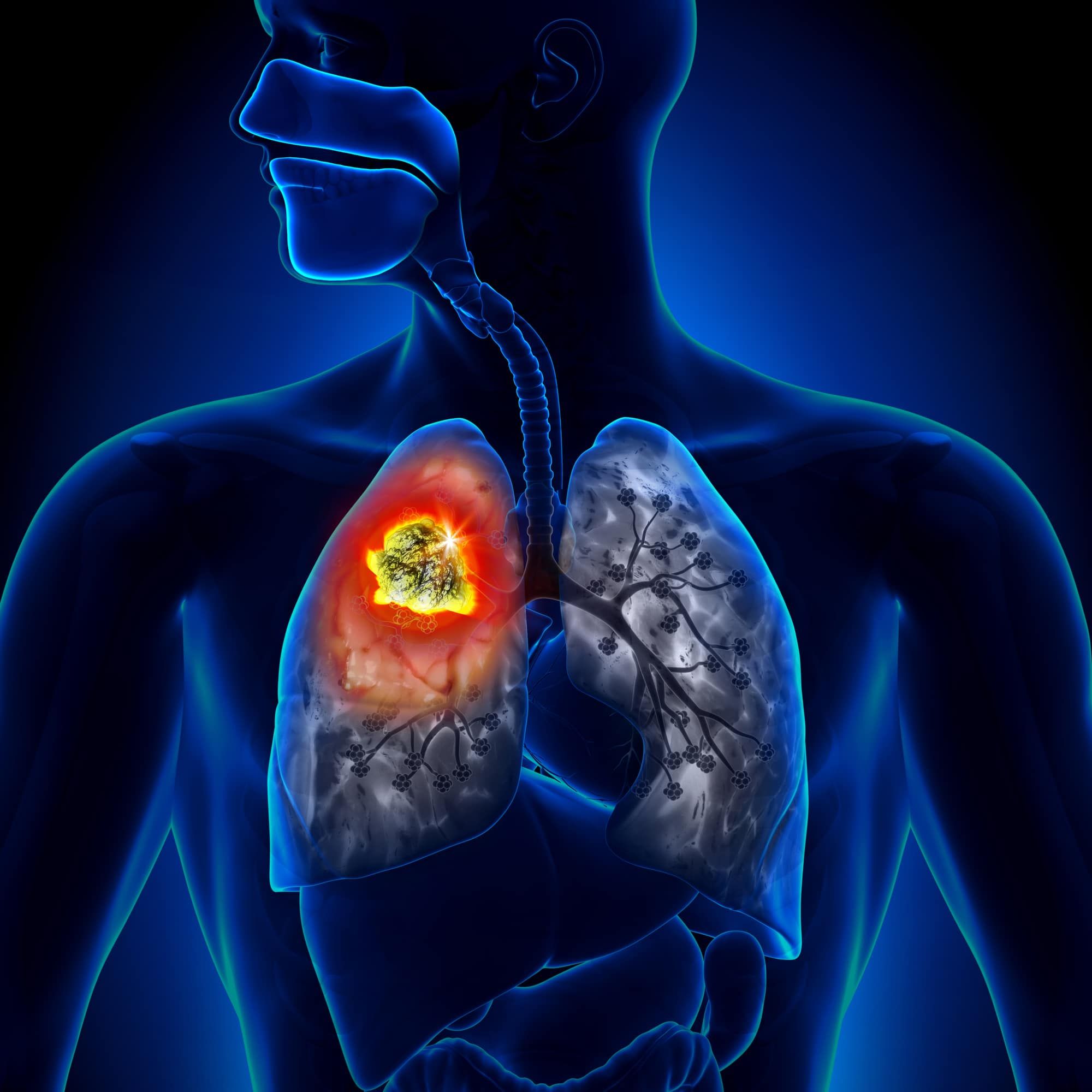 Metastatic Non Small-Cell Lung Cancer: NCCN Guidelines for Patients ...