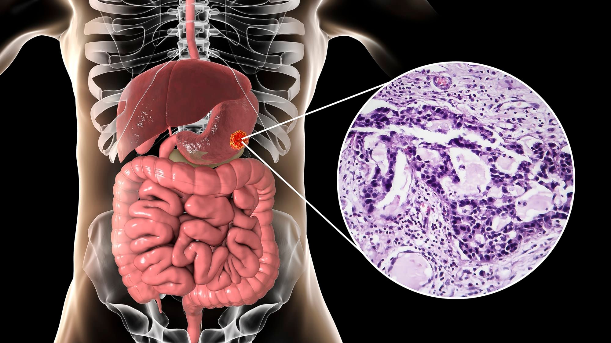 Gastric Adenocarcinoma Upper Gastrointestinal Cancer - GMKA - Global ...