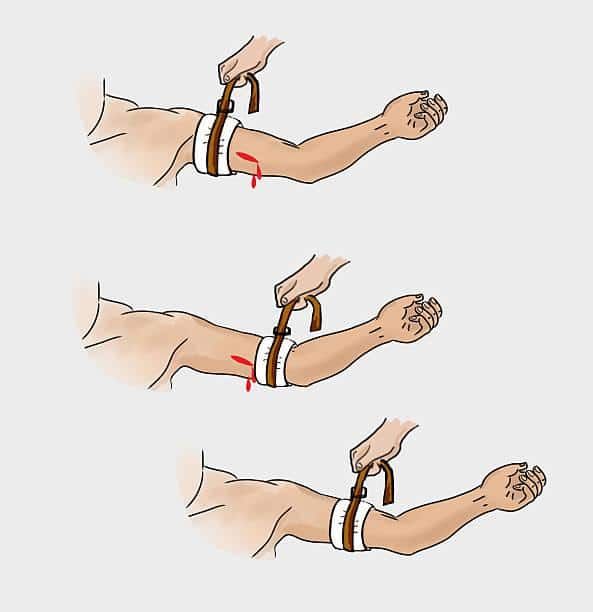 Traumatic Bleeding and Wound Management: Trauma and Emergency Education ...