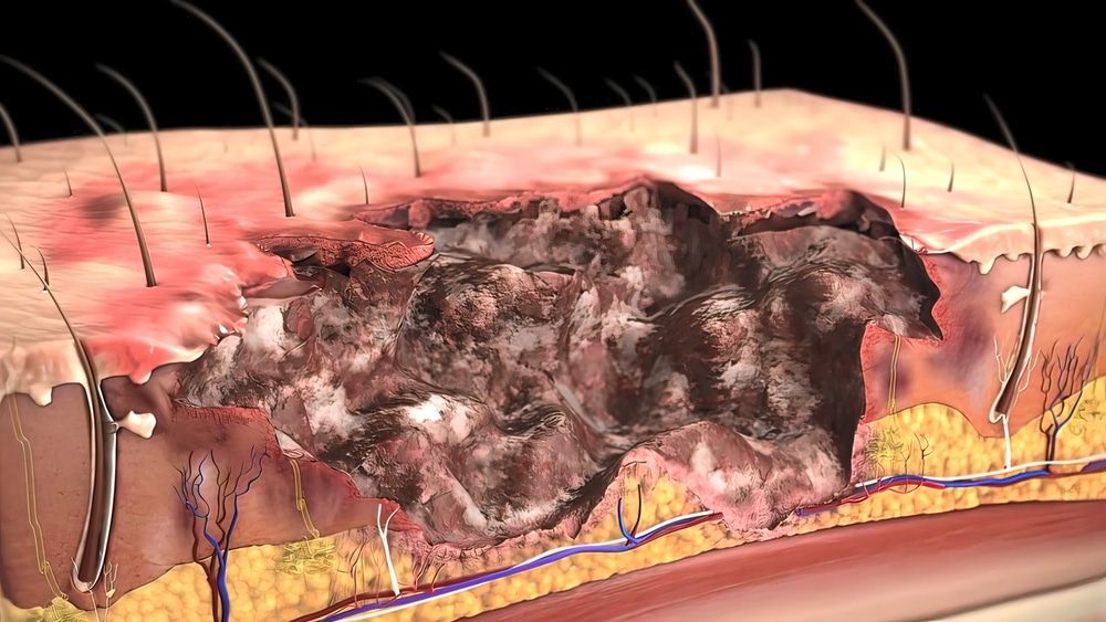 Treatment of Acute Burns Trauma Surgery - GMKA - Global Medical ...