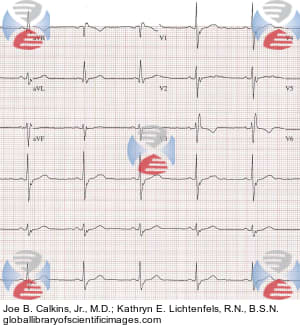 Reversal of the V1 and V3 Electrodes in a Patient with Right Bundle ...