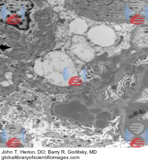 Histopathologic Features of Class IV Lupus Nephritis | Global Library ...