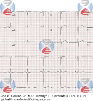 Reversal of the V2 and V3 Electrodes | Global Library of Scientific Images