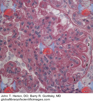 Histopathologic Features of Class IV Lupus Nephritis | Global Library ...