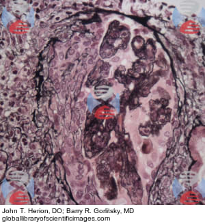 Histopathologic Features of Class IV Lupus Nephritis | Global Library ...