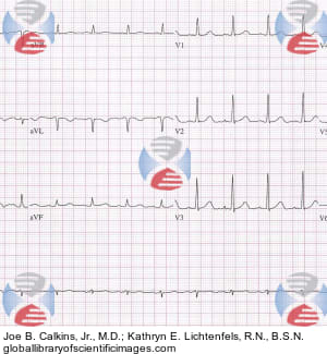 Reversal of the Arm Electrodes and of V1 and V6 | Global Library of ...