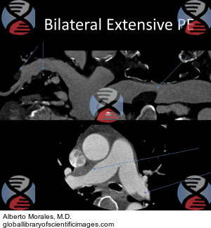 Cardiac CTA revealing Pulmonary embolism and source. | Global Library ...