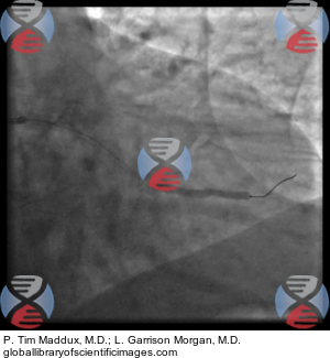 Severe Left Circumflex Stenosis | Global Library of Scientific Images