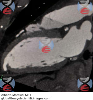 Apical Diverticulum by CTA | Global Library of Scientific Images