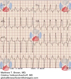 Sinus Bradycardia with Right Bundle Branch and Left Anterior Fascicular ...