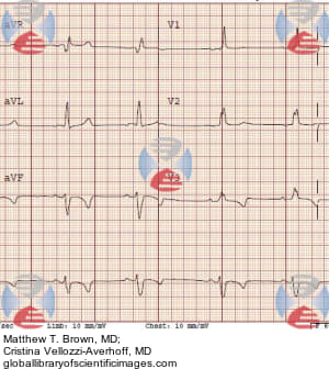 Sinus Bradycardia with Right Bundle Branch and Left Anterior Fascicular ...