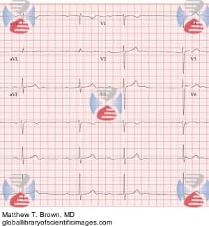 Second Degree Av Block