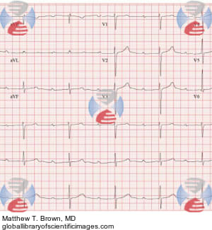 Atypical Mobitz I [Wenckebach] Like 2nd Degree Atrioventricular Block ...