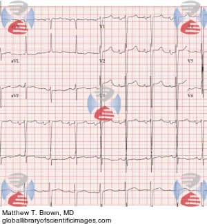 Left Ventricular Hypertrophy with Repolarization Abnormality | Global ...