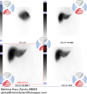 Hepatobiliary Scintigraphy | Global Library of Scientific Images
