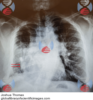 Scimitar Syndrome | Global Library of Scientific Images