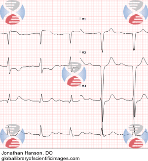 Type 2 NSTEMI in a patient with severe 3 vessel CAD | Global Library of ...