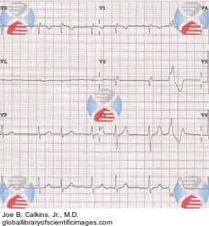 Ashman Phenomenon | Global Library of Scientific Images