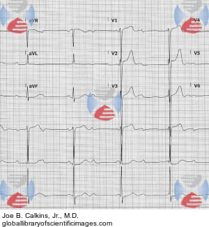 High Degree AV Block | Global Library of Scientific Images