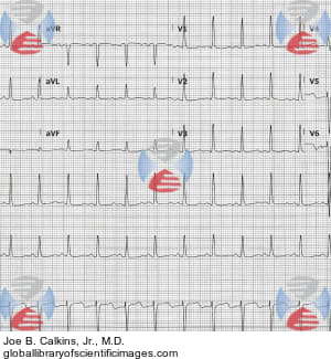 Figure 1 Reversal of all Precordial Leads | Global Library of ...